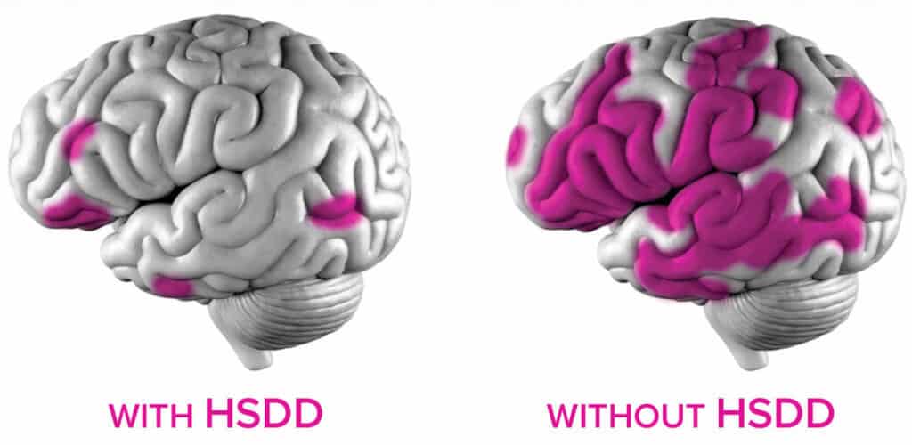 HSDD Information | Addyi® (flibanserin)